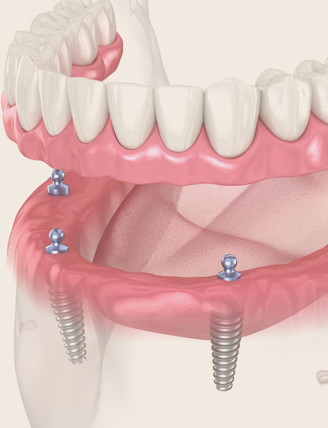 Denture Stabilisation - Shirland Dental Practice | Dentist in Maida ...